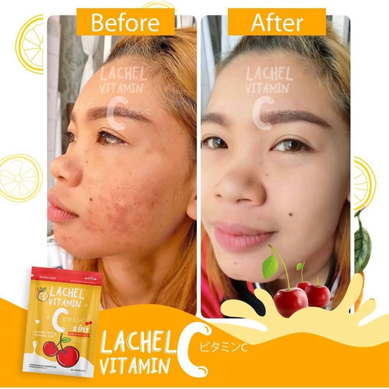 Lachel: gélules Vitamine C 1000mg – luxurious-queen.fr
